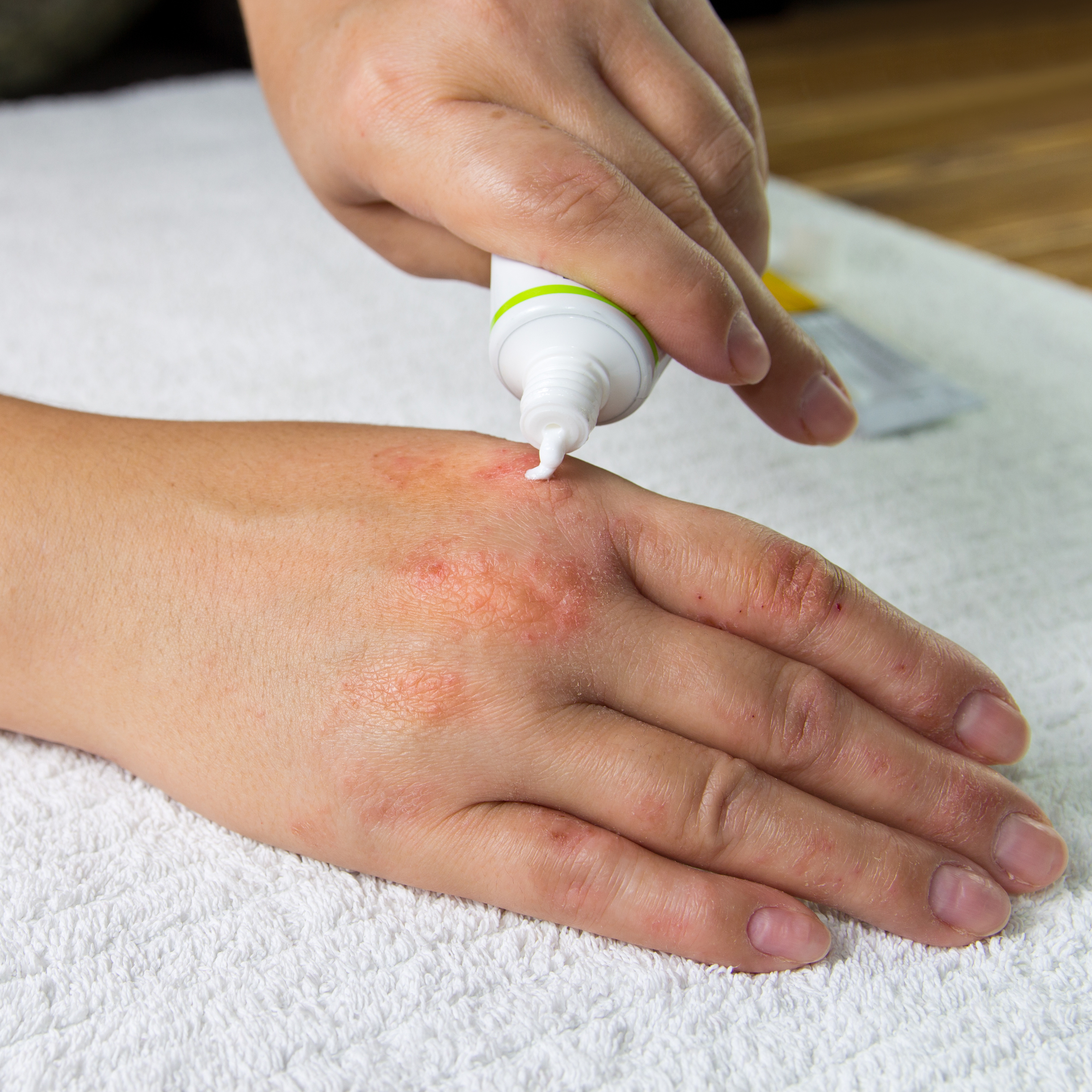 Corticosteroid allergy - Dermatitis Academy